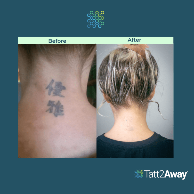 Before & After Pictures - Natural Tattoo Removal - Tatt2Away