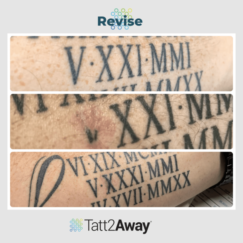 Before & After Pictures - Natural Tattoo Removal - Tatt2Away