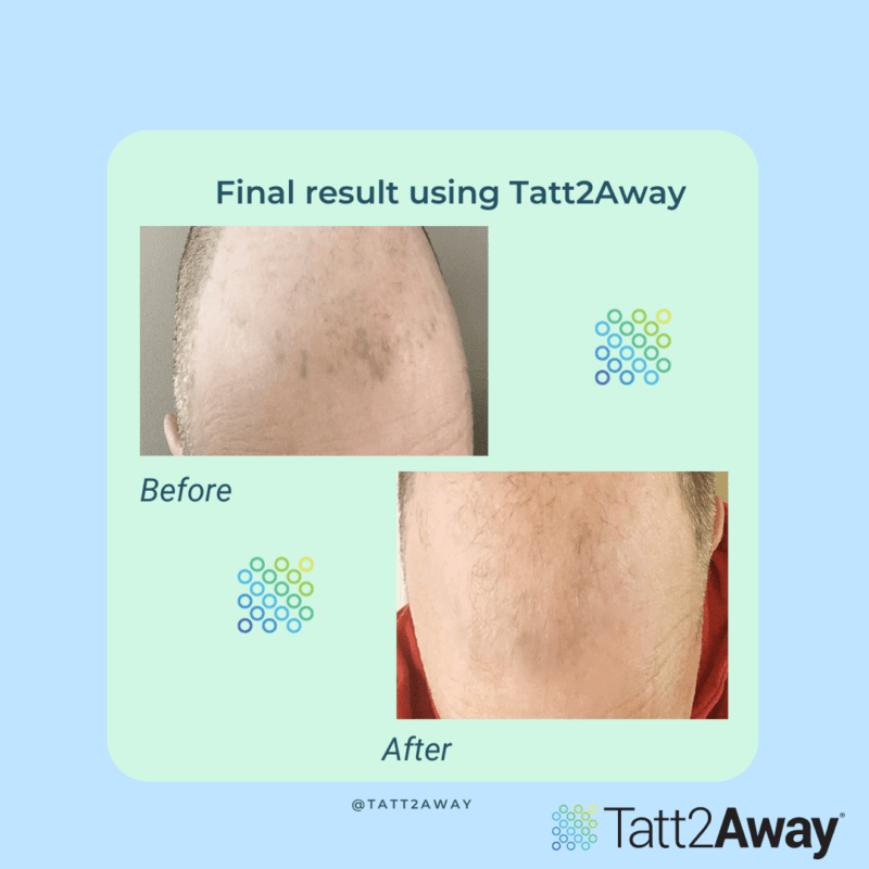 Before & After Pictures - Natural Tattoo Removal - Tatt2Away