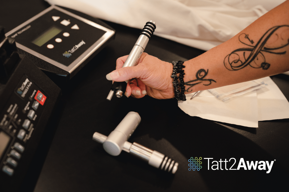 Sleeve Tattoo Removal Services by Tatt2Away