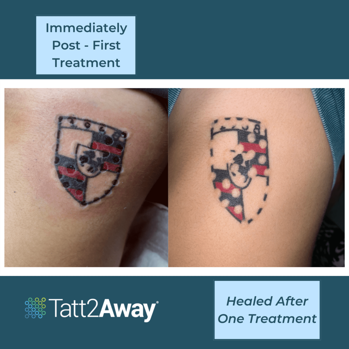 Before & After Pictures - Natural Tattoo Removal - Tatt2Away