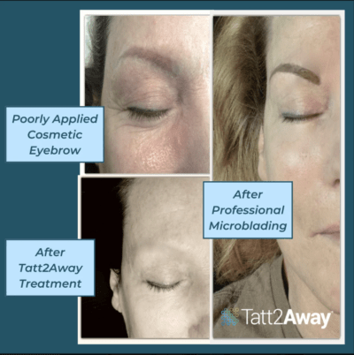 Non-Laser Tattoo Removal and Cover Up | Tatt2Away