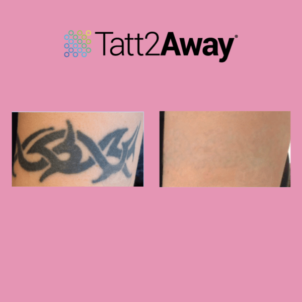 Fitzpatrick Scale: Tattoo Removal on All Skin Tones