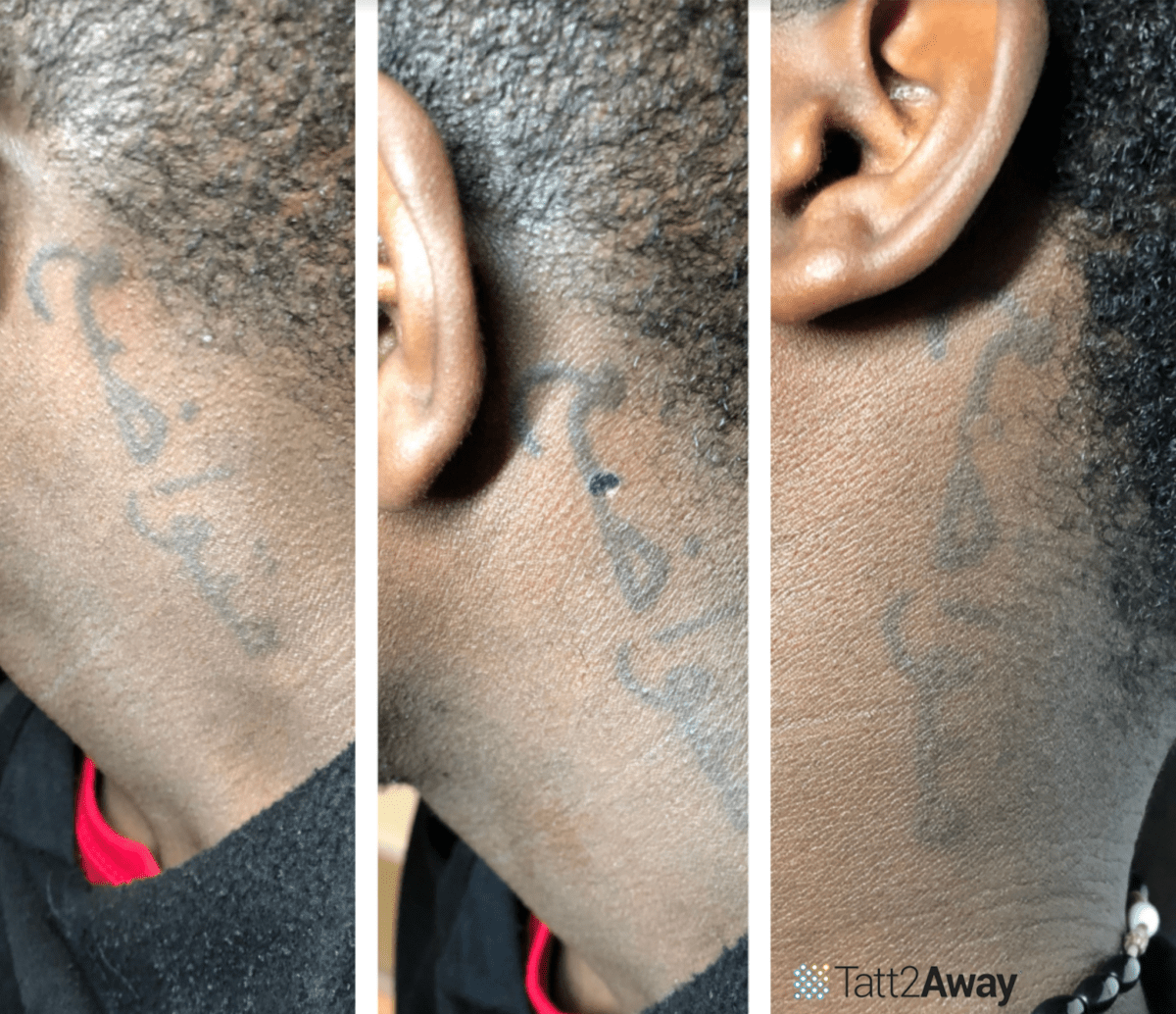 Truth Revealed: Tattoo Removal on Dark Skin