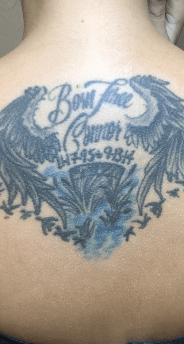 Tattoo Removal Before and After Pictures - Tatt2Away®