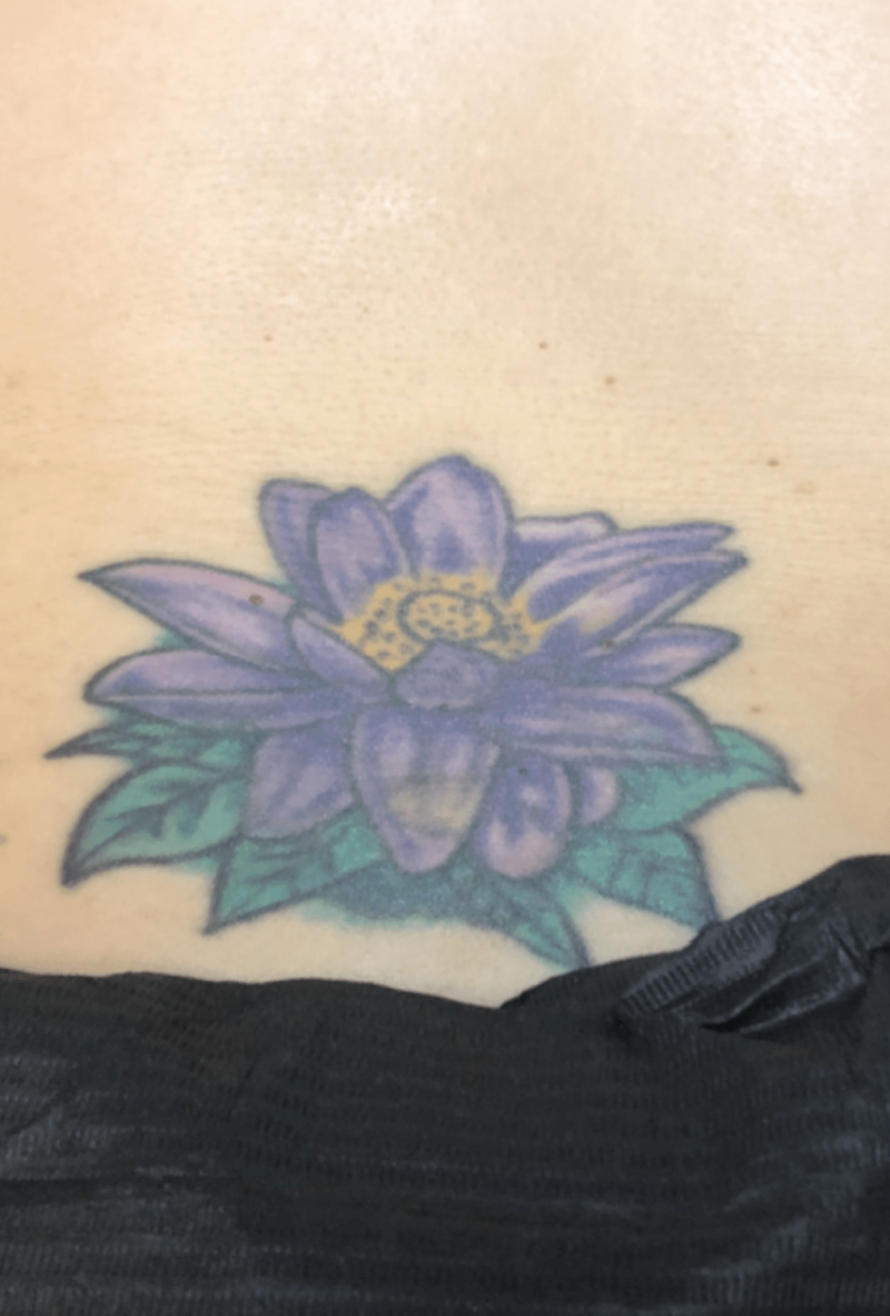 Tattoo Removal Before and After Pictures - Tatt2Away®