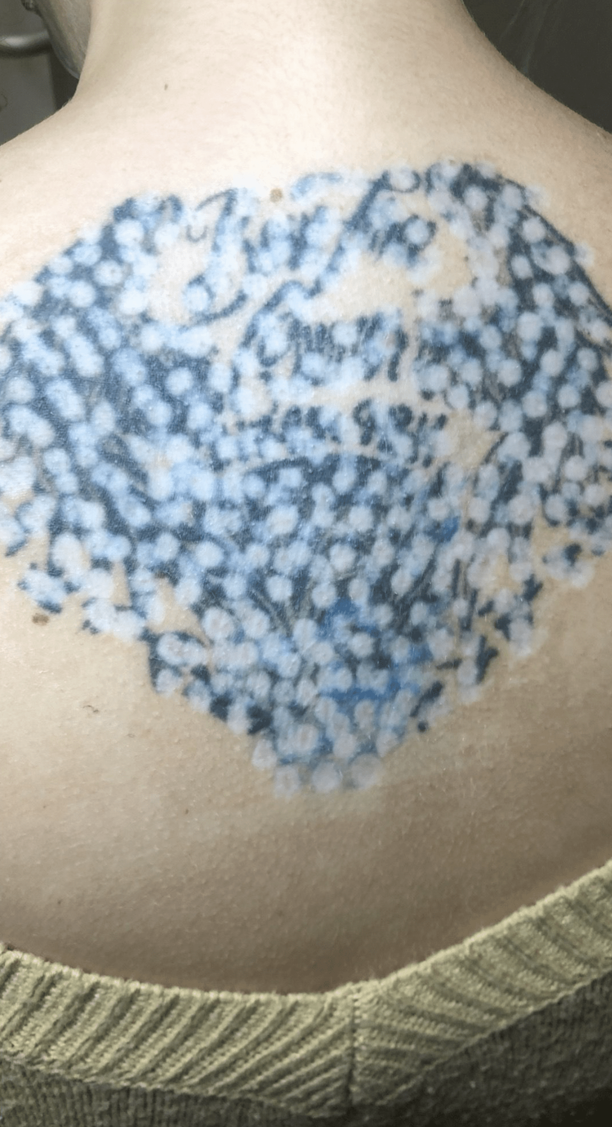 Tattoo Removal Before and After Pictures - Tatt2Away®