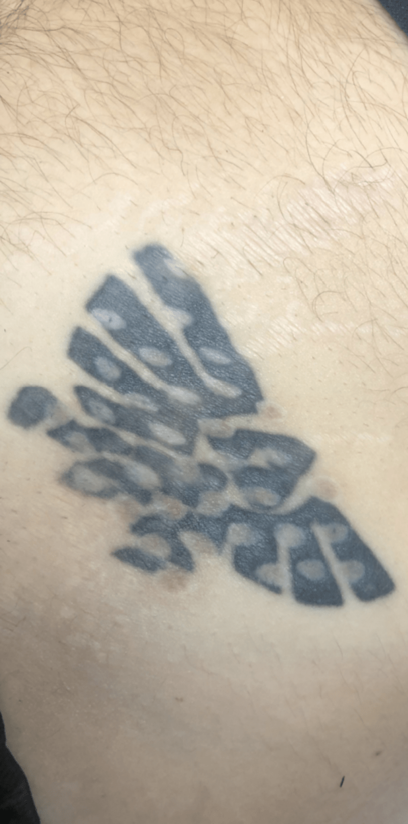 Tattoo Removal Before and After Pictures - Tatt2Away®