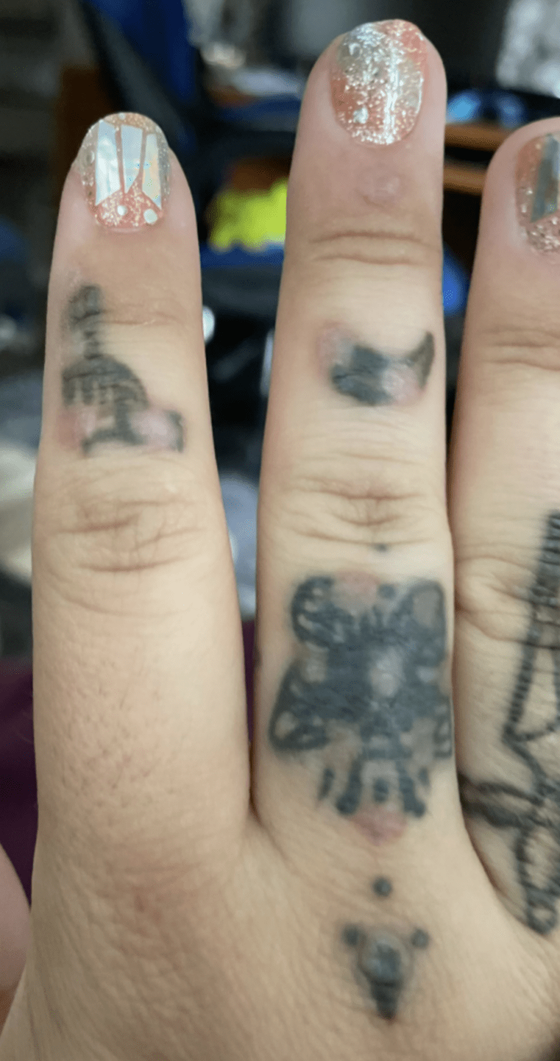Tattoo Removal Before and After Pictures - Tatt2Away®
