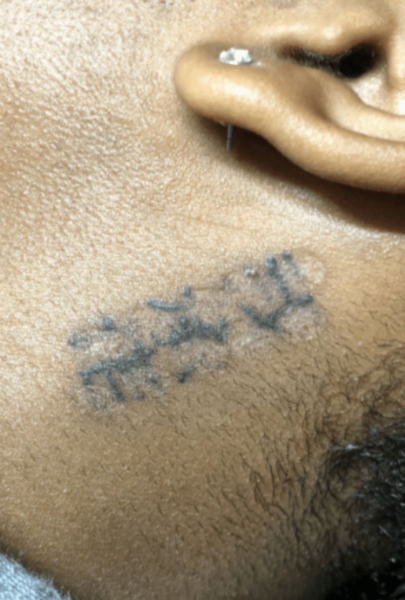 Tattoo Removal Before and After Pictures - Tatt2Away®