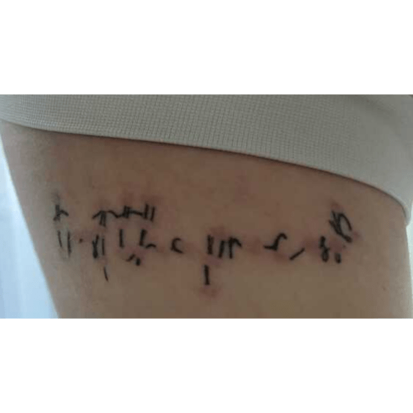 Tattoo Removal Before and After Pictures - Tatt2Away®